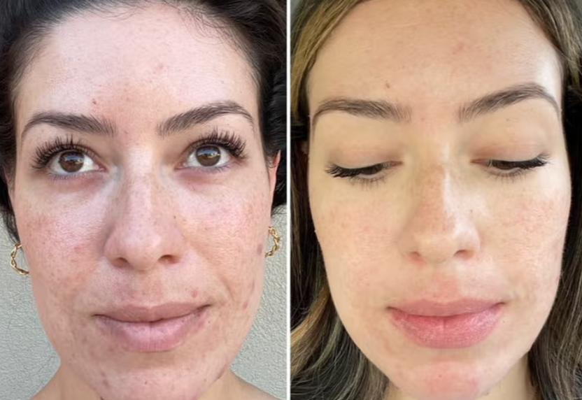 Refresh Your Skin with Medical Grade Microneedling | Medspa of Tampa